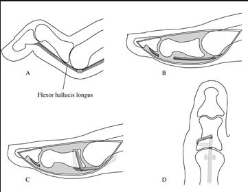 Question 3859 - Qbank - Orthobullets