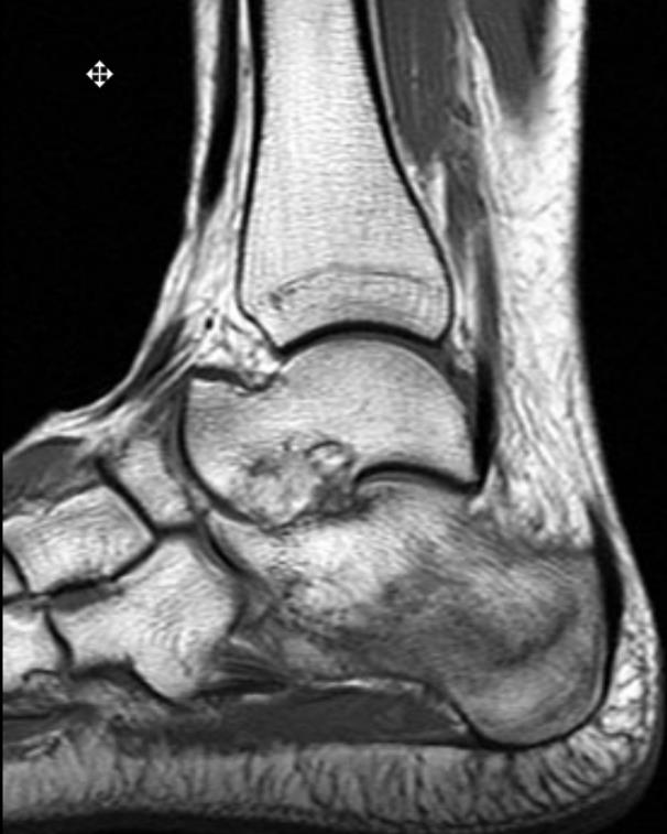 Calcaneus Fractures - Trauma - Orthobullets
