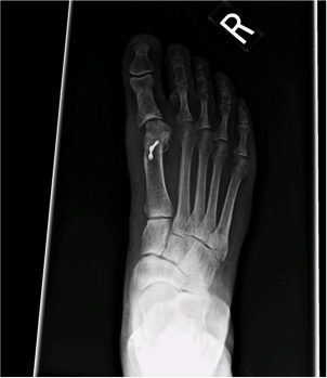 Hallux Varus - Foot & Ankle - Orthobullets