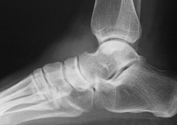 Pigmented Villonodular Synovitis - Pathology - Orthobullets