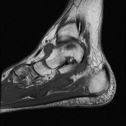 Pigmented Villonodular Synovitis - Pathology - Orthobullets