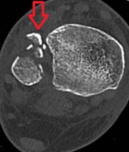 High Ankle Sprain & Syndesmosis Injury - Foot & Ankle - Orthobullets
