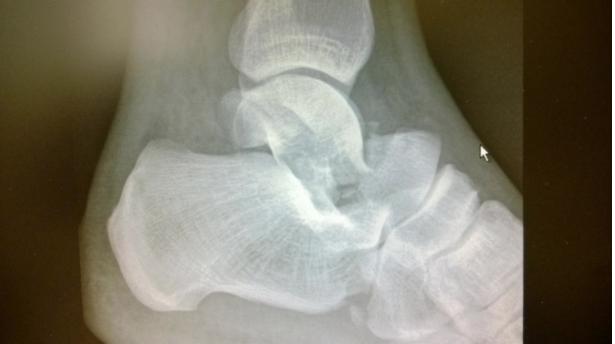 Talar Neck Fractures - Trauma - Orthobullets