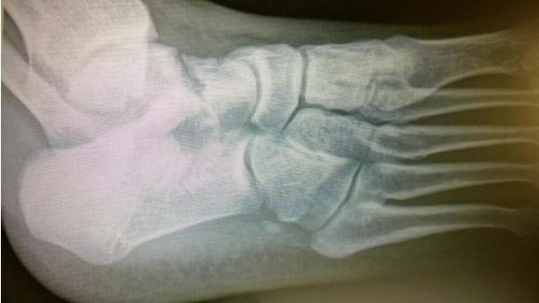 Talar Neck Fractures - Trauma - Orthobullets