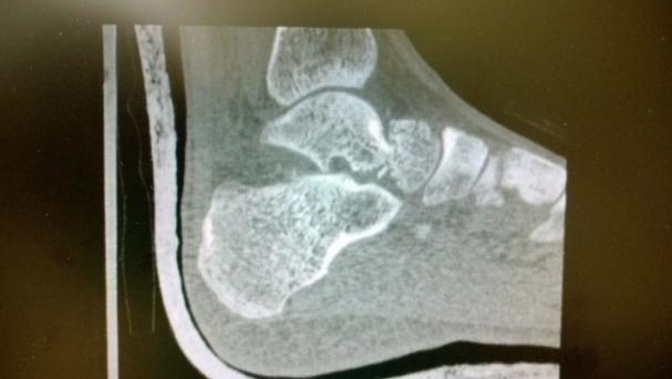 Talar Neck Fractures - Trauma - Orthobullets
