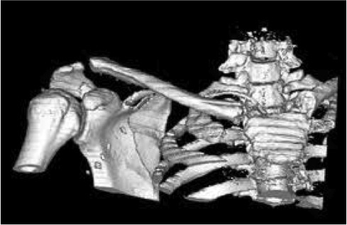 Scapulothoracic Dissociation - Trauma - Orthobullets