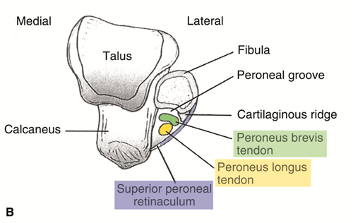 Peroneal Tendon Subluxation & Dislocation - Foot & Ankle - Orthobullets