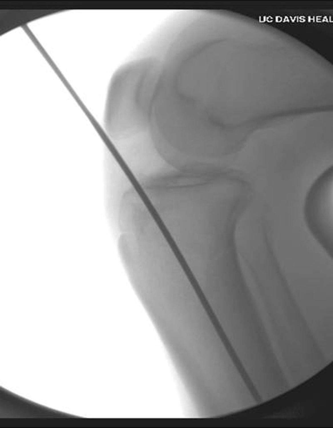 Question 3969 - Qbank - Orthobullets