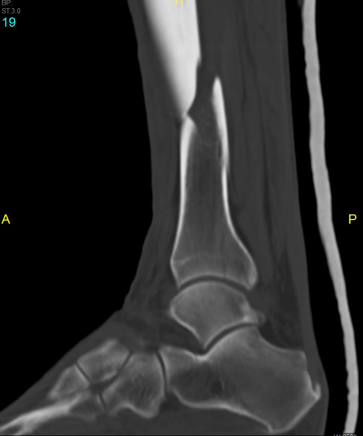 Question 3992 - Qbank - Orthobullets