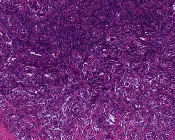 Synovial Sarcoma - Pathology - Orthobullets