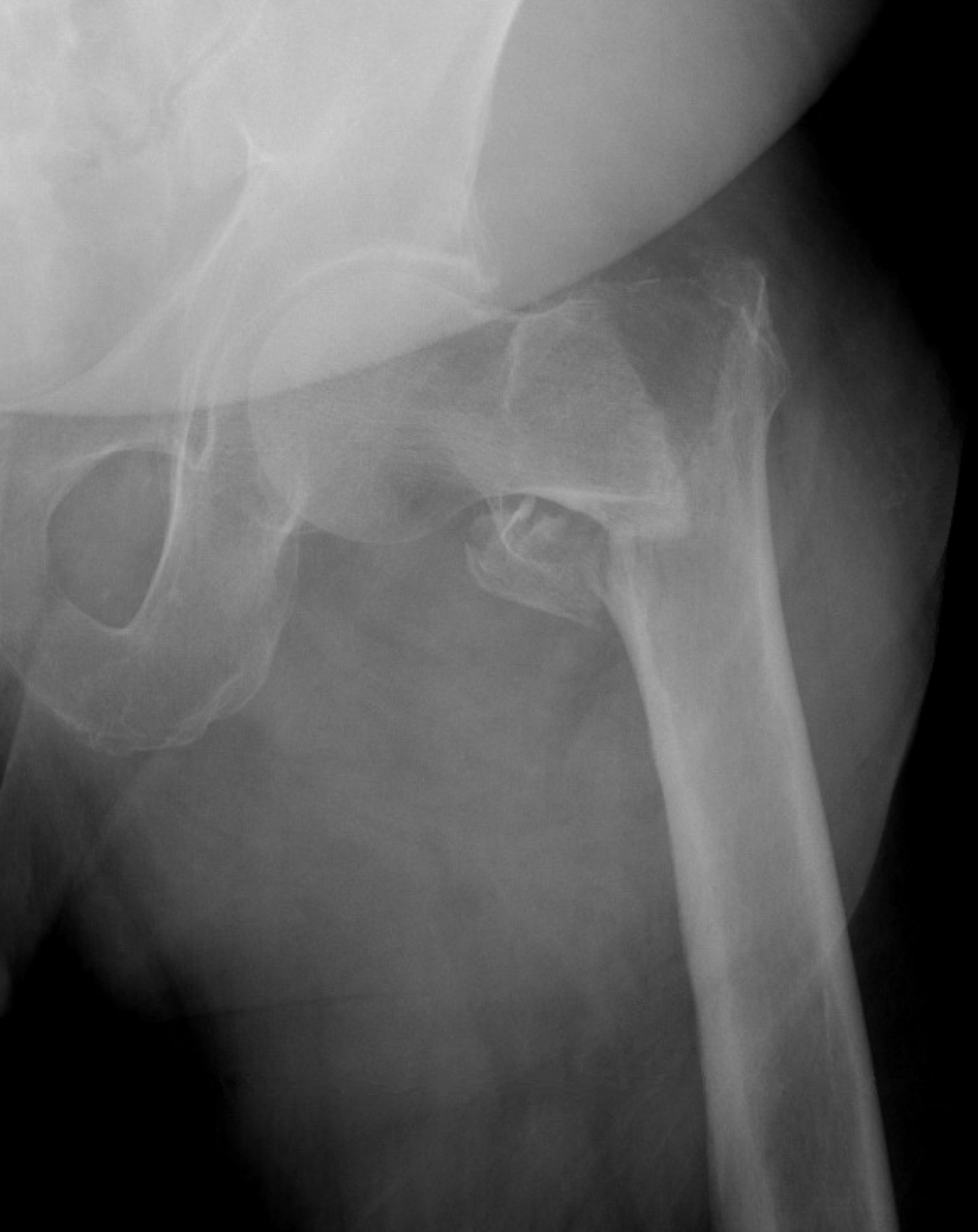 Fracture Healing - Basic Science - Orthobullets