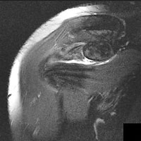 Adhesive Capsulitis (Frozen Shoulder) - Shoulder & Elbow - Orthobullets