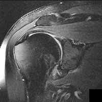 Adhesive Capsulitis (Frozen Shoulder) - Shoulder & Elbow - Orthobullets