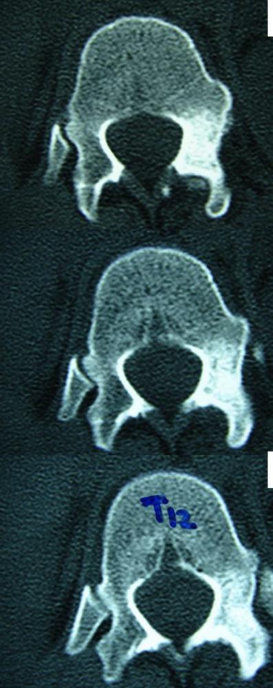 Osteoid Osteoma - Pathology - Orthobullets