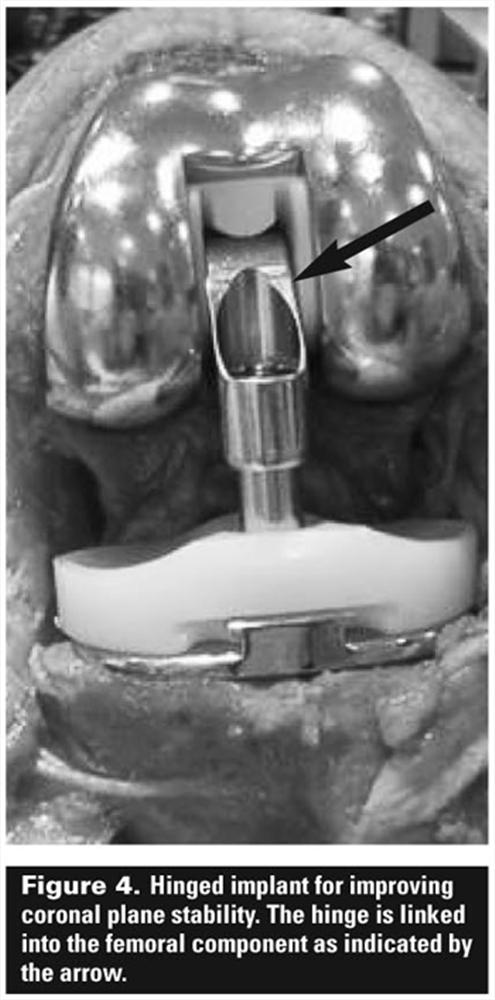 TKA Prosthesis Design - Recon - Orthobullets