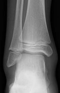 Osteomyelitis - Pediatric - Pediatrics - Orthobullets