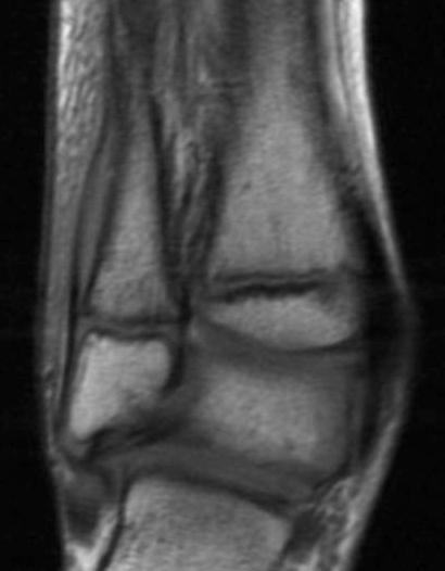 Osteomyelitis - Pediatric - Pediatrics - Orthobullets