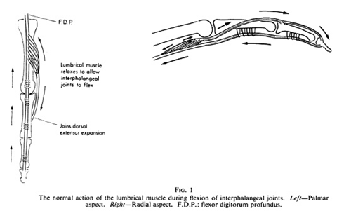 Lumbrical Plus Finger - Hand - Orthobullets