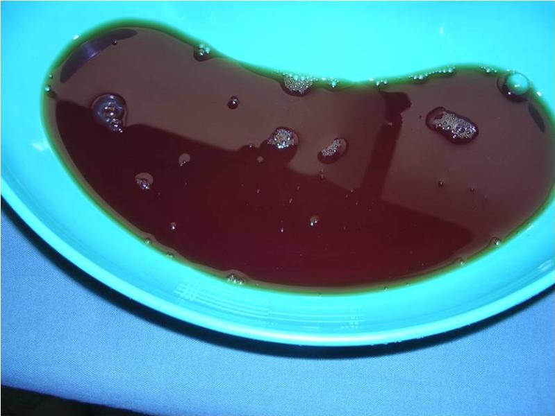 Pigmented Villonodular Synovitis - Pathology - Orthobullets