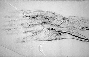 Thromboangiitis Obliterans (Buerger's disease) - Hand - Orthobullets