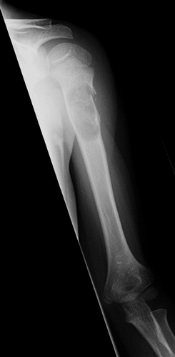 Unicameral Bone Cyst - Pathology - Orthobullets