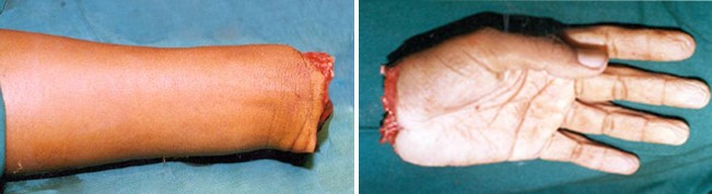 Replantation - Hand - Orthobullets