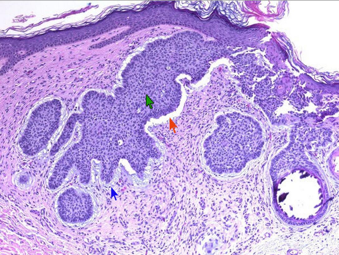 Osteomyelitis - Adult - Trauma - Orthobullets