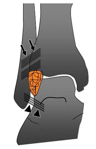 Tibiotalar Impingement - Foot & Ankle - Orthobullets