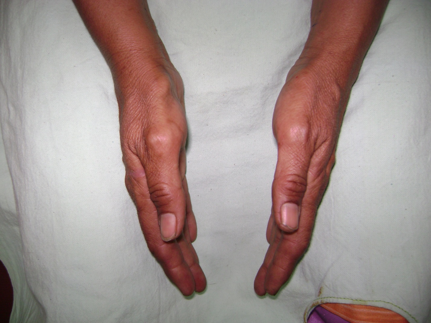 Peripheral Nerves Injury & Repair - Hand - Orthobullets