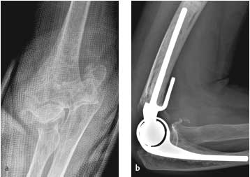 Distal Humerus Fractures - Trauma - Orthobullets