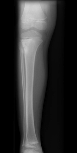 Osteosarcoma Orthobullets