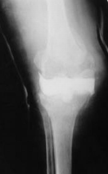 Prosthetic Joint Infection - Recon - Orthobullets