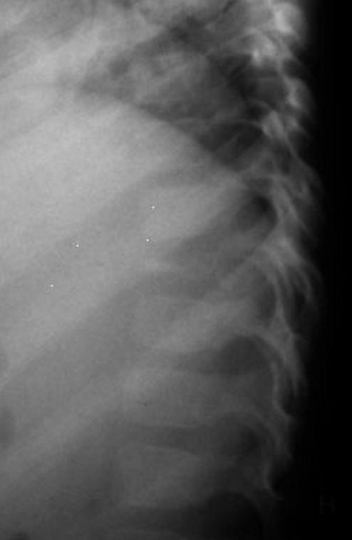 Eosinophilic Granuloma - Pathology - Orthobullets