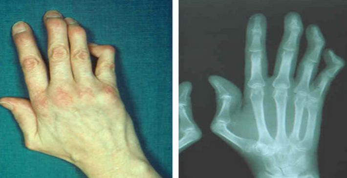 Basilar Thumb Arthritis - Hand - Orthobullets