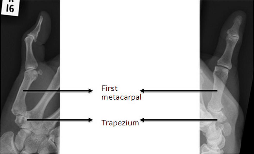 Basilar Thumb Arthritis - Hand - Orthobullets