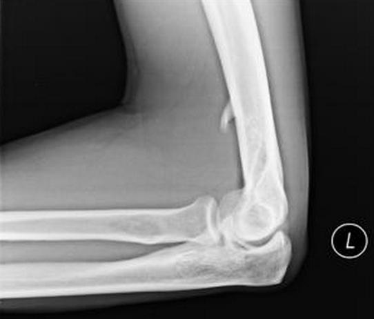 Opponensplasty by extensor indicis and flexor digitorum superficialis ...