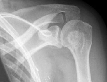 Mirels' rating for humerus lesions is both reproducible and valid ...