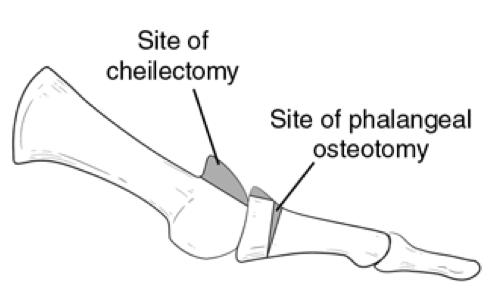 Cheilectomy Osteotomy Moberg Dorsal Foot Metatarsal Proximal Phalangeal ...