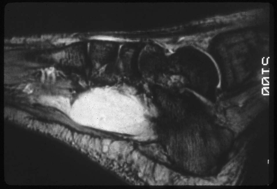 Synovial Sarcoma - Pathology - Orthobullets