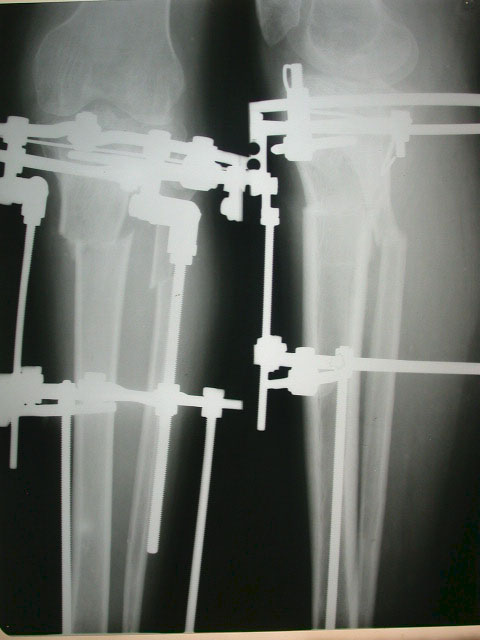 Question 4831 - Qbank - Orthobullets