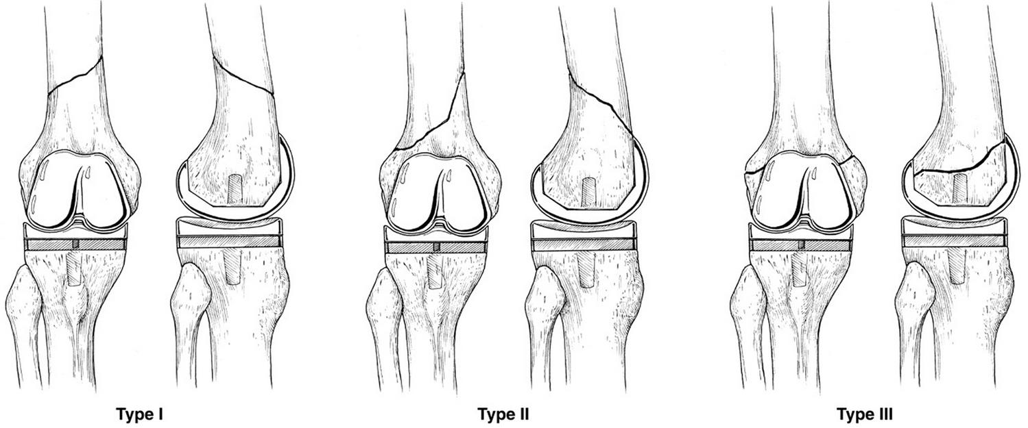 Question 4835 - Qbank - Orthobullets
