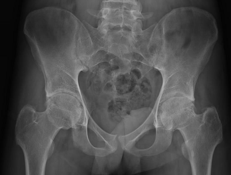 Ankylosing Spondylitis - Spine - Orthobullets