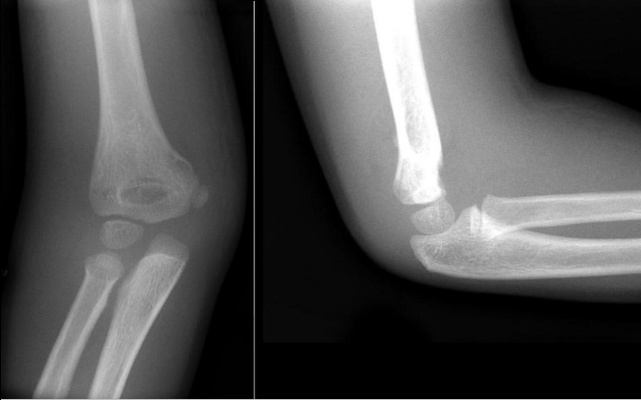 Supracondylar Humerus Supracondylar Humerus