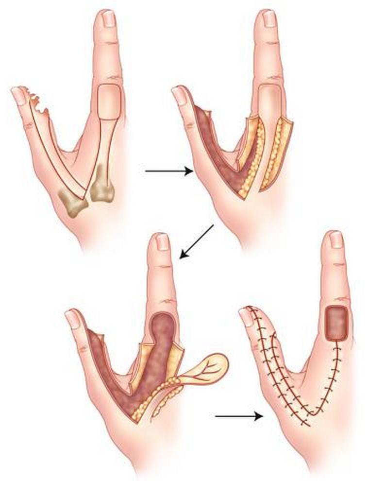 Question 4875 - Qbank - Orthobullets