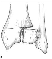 Tillaux Fractures - Pediatrics - Orthobullets