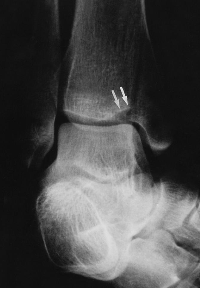 Ankle Fractures - Trauma - Orthobullets