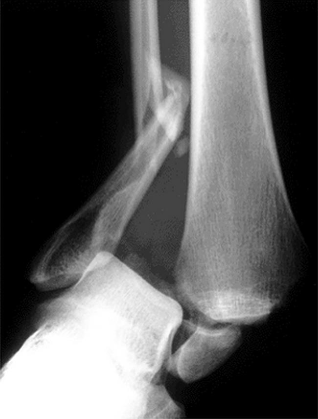 Ankle Fractures - Trauma - Orthobullets