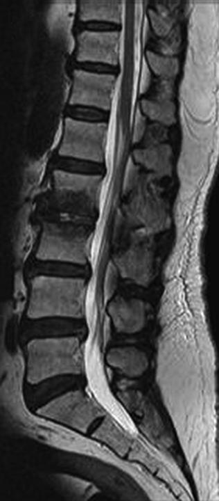 Adult Pyogenic Vertebral Osteomyelitis - Spine - Orthobullets