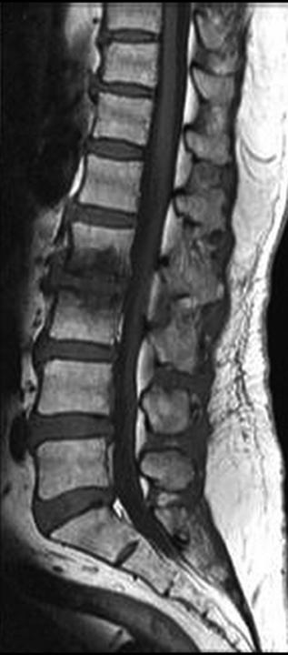 Adult Pyogenic Vertebral Osteomyelitis - Spine - Orthobullets