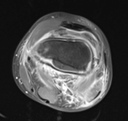 Osteomyelitis - Pediatric - Pediatrics - Orthobullets